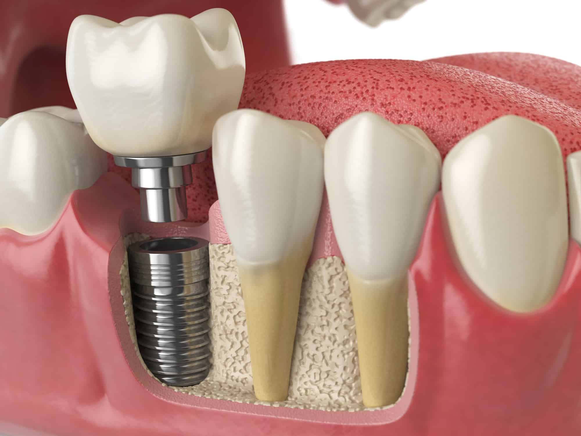 Εμφυτεύματα δοντιών Θεσσαλονίκη • FILIS DENTAL CLINIC